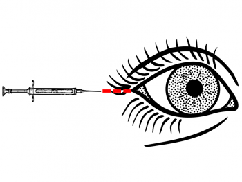 Lateral Canthotomy - procedure guide - First10EM