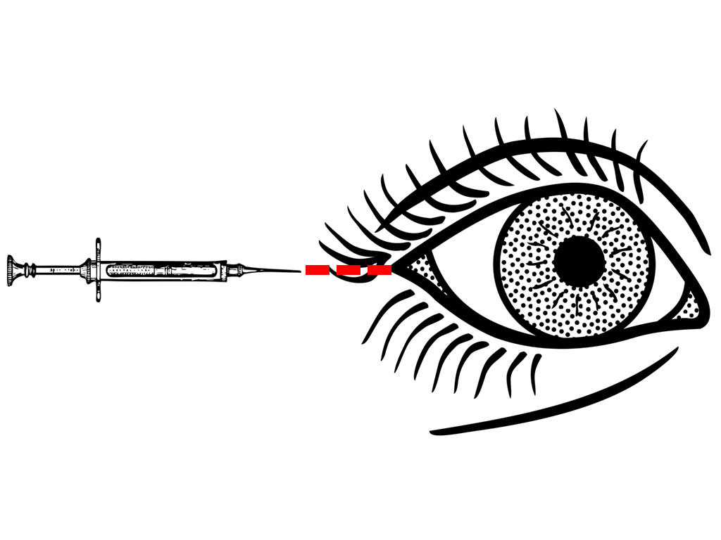 Lateral Canthotomy - procedure guide - First10EM