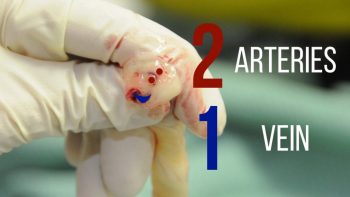 Procedure: Umbilical Vein Catheterization - First10EM