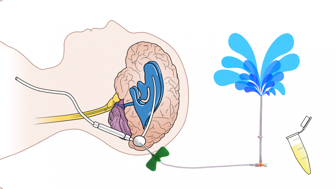 VP shunt malfunction - First10EM