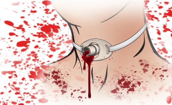 Airway Archives - Page 2 of 2 - First10EM