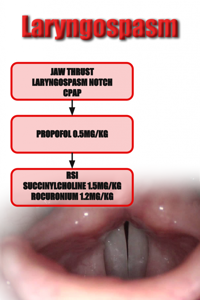 First10EM laryngospasm management - First10EM