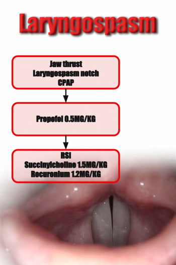 Managing laryngospasm in the emergency department - First10EM