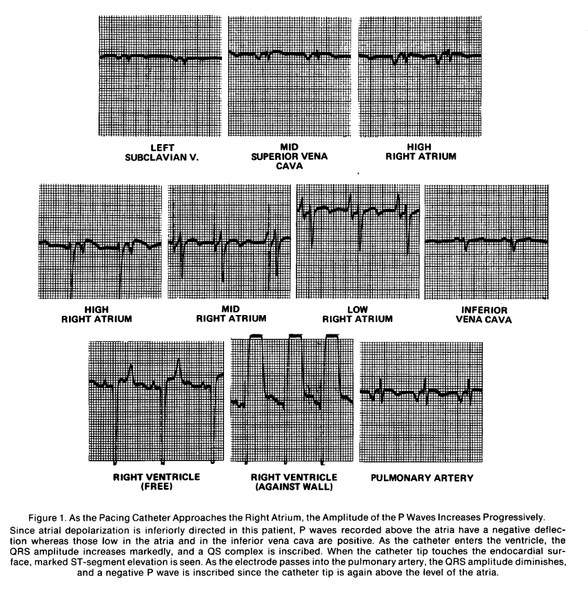Emergent Cardiac Pacing - First10EM
