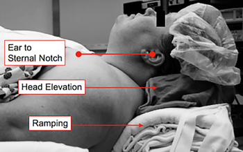 Emergency Airway Management Part 3: Intubation - the procedure - First10EM